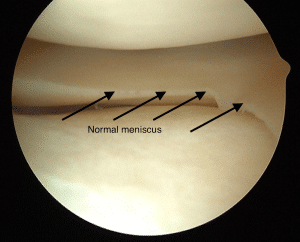 Normal meniscus-label - Specialty Orthopaedics